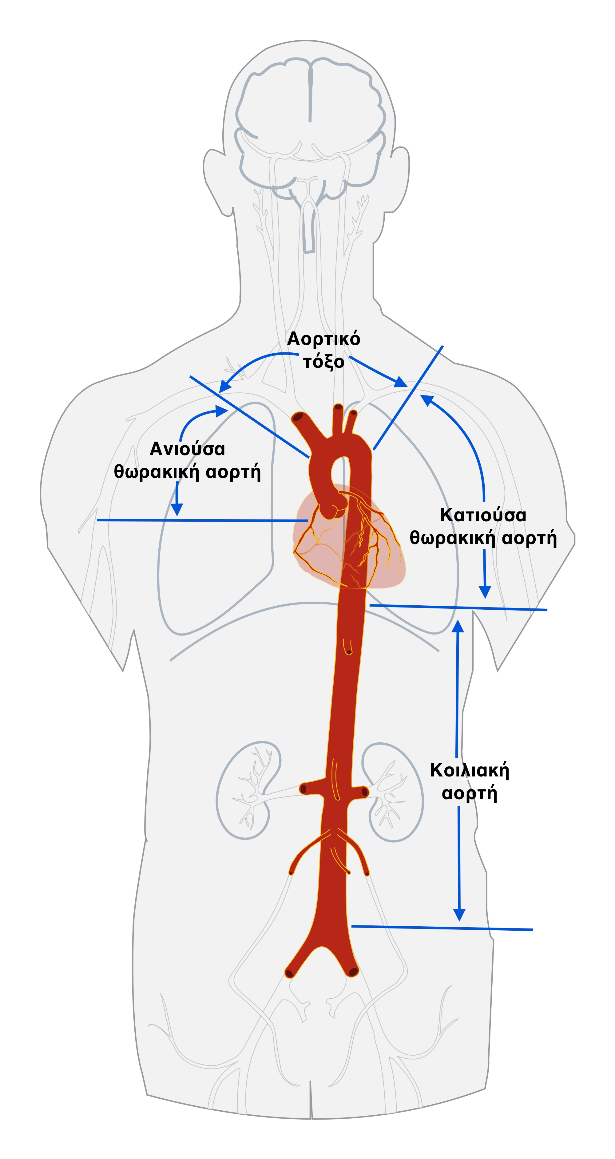 Ανεύρυσμα Θωρακικής Αορτής - Νικόλαος Τσεκούρας